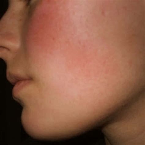 Rashes On Face
