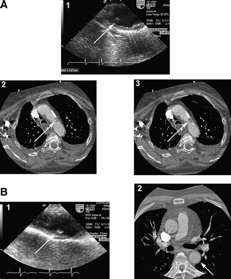 Comparison Of Computed Tomography Angiography And Transesophageal
