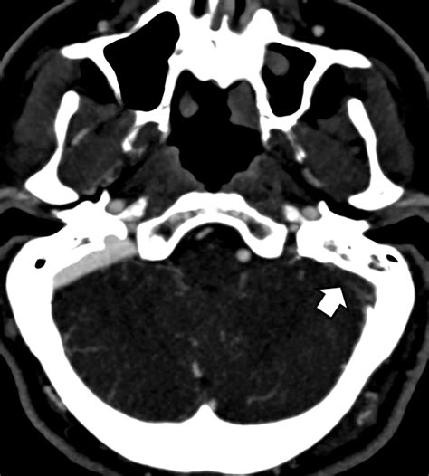 Ct Of Skull Base Fractures Classification Systems Complications And