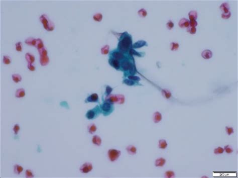 Cytospin Performance When Using Paris System For Reporting Urinary