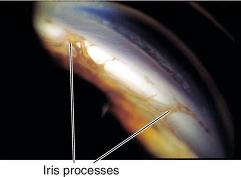 Iris Processes Gonioscopy Angle Iris Processes Gonioscopy Angle