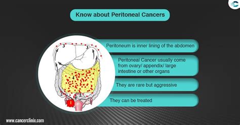 Peritoneal Surface Malignancy Cancerclinix