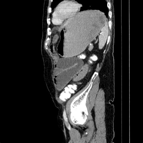 File Small Bowel Volvulus Causing Small Bowel Obstruction Mimicking Intussusception