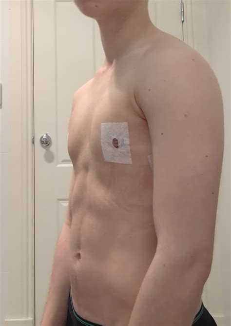Radical Reductionnon Binary Top Surgery 2 Month Recovery Rtopsurgery Radical Reductionnon Binary Top Surgery 2 Month Recovery Rtopsurgery