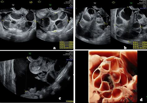Ovarian Fibroma Ultrasound