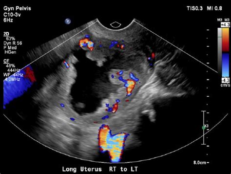 Uterine Cancer Symptoms Ultrasound