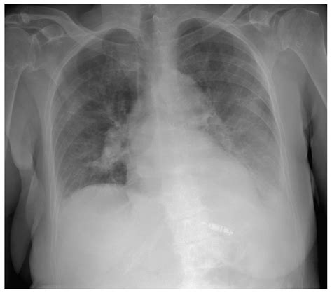 Ijerph Free Full Text Implantation Of A Leadless Pacemaker After Incomplete Transvenous Lead