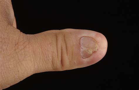 Grafting And Other Reconstructive Options For Nail Deformities Hand