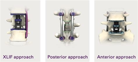 Product Detail Neurospine