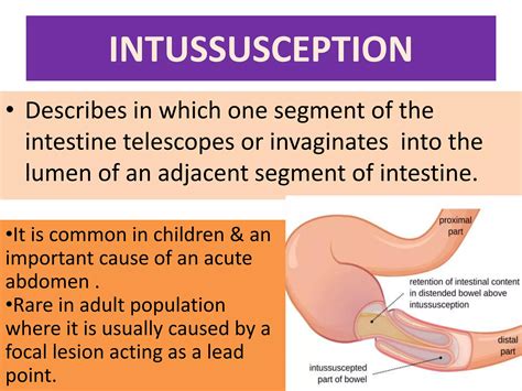 Intussusception In Adults Submucosal Lipoma At Transverse Colon A Rare