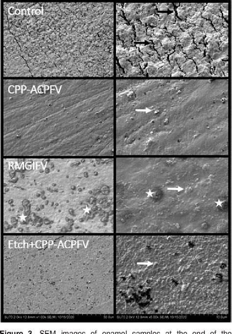 Figure 1 From Efficacy Of Cpp Acp Fluoride Varnish Applied With And Without Acid Etching In