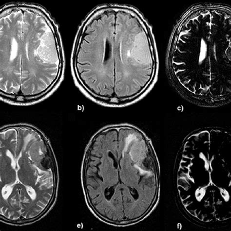 Qualitatively Assessed CSF Spaces In The Braintumor Interface Presented Download Scientific