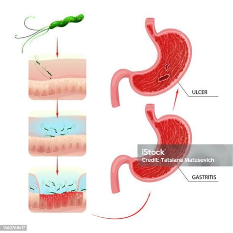 위장의 위염 및 궤양 발생 과정 건강관리와 의술에 대한 스톡 벡터 아트 및 기타 이미지 건강관리와 의술 과학 교육 Istock