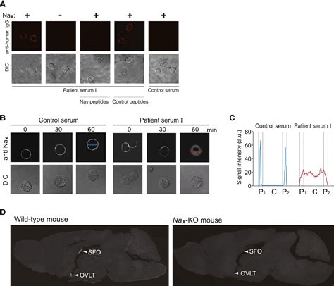 Autoimmunity To The Sodium Level Sensor In The Brain Causes Essential