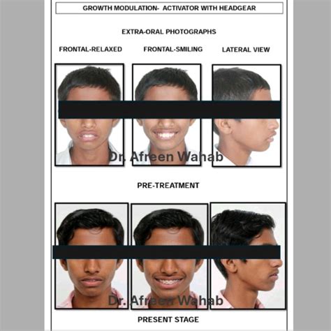 A 15 Year Old Male Patient With Skeletal Base Class Ii And Vertical