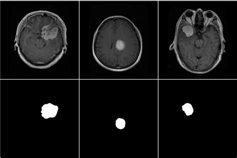 [论文审查] Improved Unet Brain Tumor Image Segmentation Based On Gsconv Module And Eca Attention