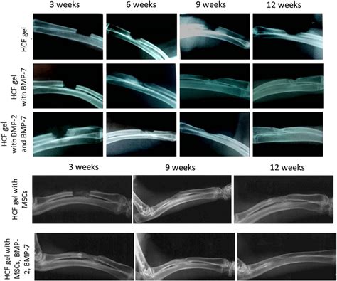 Dynamics Of The Bone Defect Regeneration After Hcf Implantation With Download High