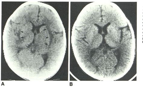 Figure 3 From Ct Of Subinsular Infarction And Ischemia Semantic Scholar