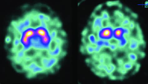 Normal And Abnormal Dat Spect Scans The Image On The Left Shows Normal Download Scientific