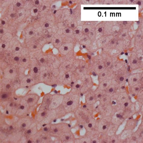 Hepatitis B Libre Pathology