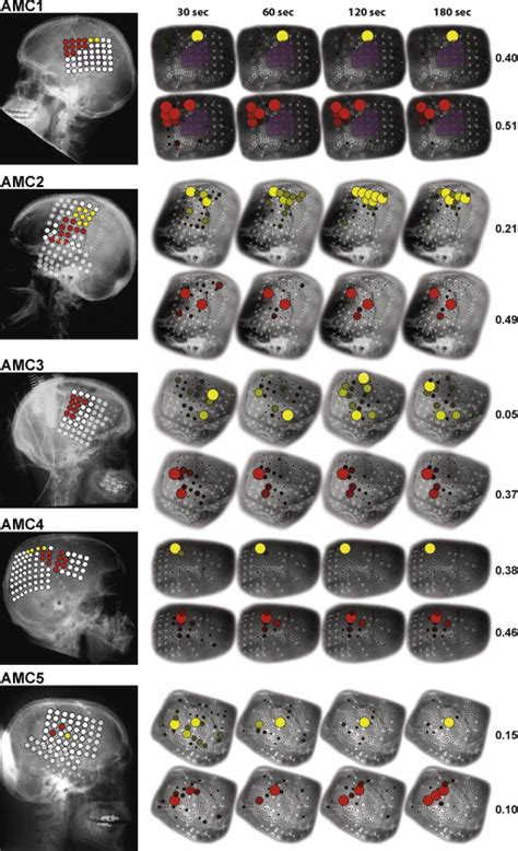 A Practical Procedure For Real Time Functional Mapping Of Eloquent Cortex Using