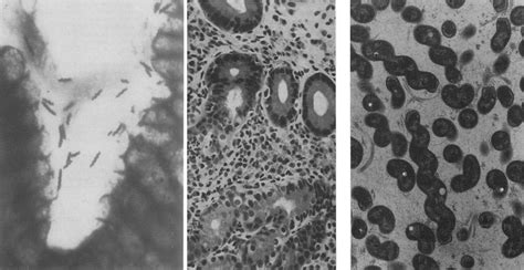 The First 5 Years Of Helicobacter Pylori Research—with An Emphasis On The United Kingdom