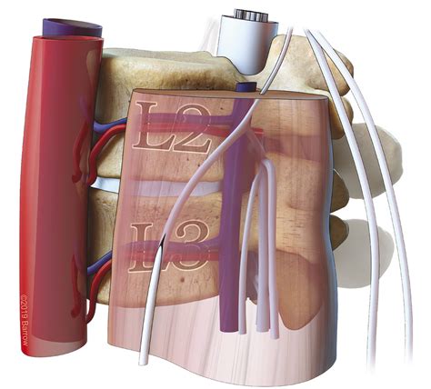 Minimally Invasive Lateral Transpsoas Interbody Lumbar Fusion Neupsy Key