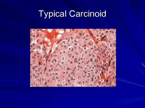 Bronchial Carcinoid Tumors Heather Wheeler Md February 4