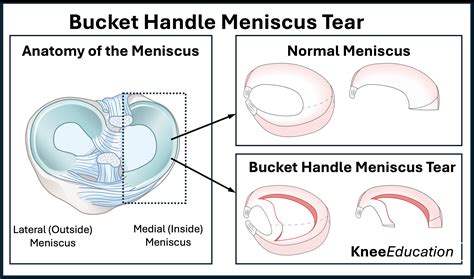 Bucket Handle Meniscus Tear Knee Education