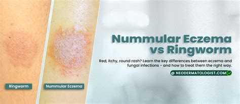 Nummular Eczema Vs Ringworm Differences Symptoms And Treatment