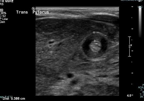 Pyloric Stenosis Ultrasound Protocol
