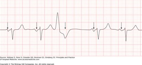 Ventricular Quadrigeminy
