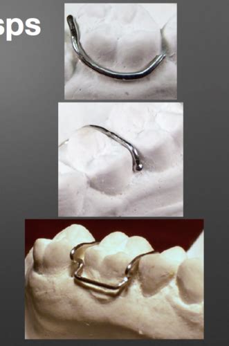 4 23 Interim Partial Denture Flashcards Quizlet