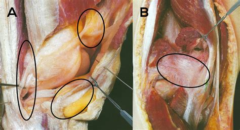 Arthrofibrosis A Multifaceted Immunological Problem