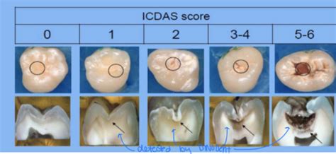Caries Detection Diagnosis Treatment Flashcards Quizlet
