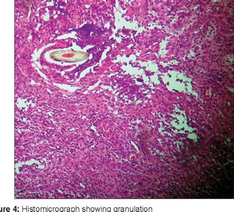 Figure 1 From Umbilical Pilonidal Sinus A Rare Presentation