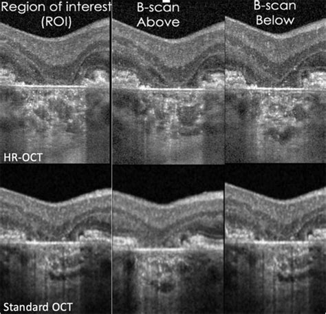 Atrophic Lesions Associated With Age Related Macular Degeneration