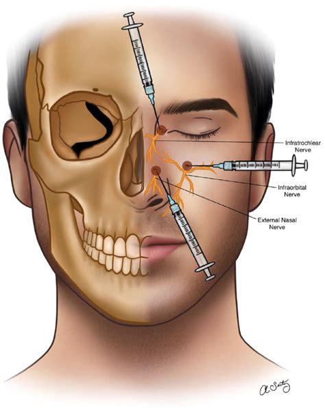 Maxillary Nerve Block Technique