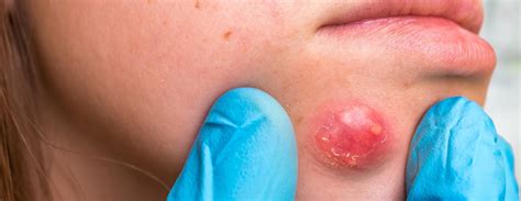 دانه بیخ کته یا فرانکل چیست؟