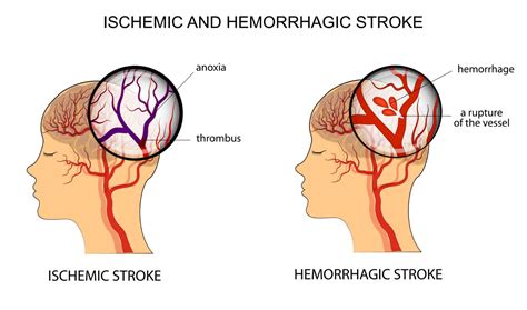 Stroke Assessment In The Ed Acls Resources Acls Certification