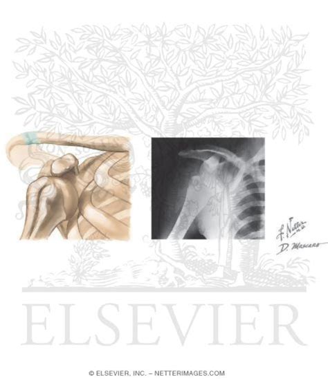 Subcoracoid Dislocation