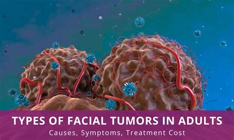 Types Of Facial Tumors In Adults Causes Symptoms Treatment Cost