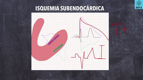 Isquemia Subepicárdica E Grave Retoedu