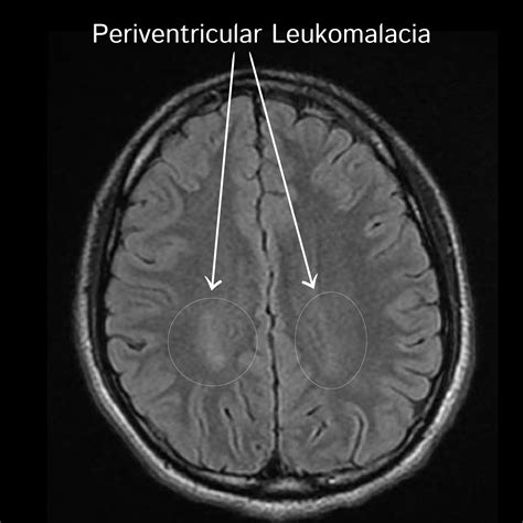Clinical Pathology Glossary Periventricular Leukomalacia Ditki Medical And Biological Sciences