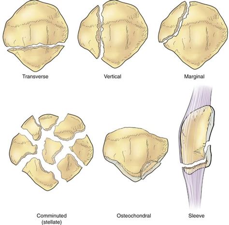 Patella Fracture Classification