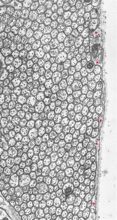 Cerebellum Clinical Tree
