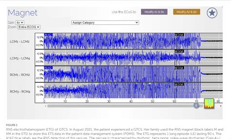 Figure 1 From Centromedian Thalamic Neuromodulation For The Treatment Of Idiopathic Generalized