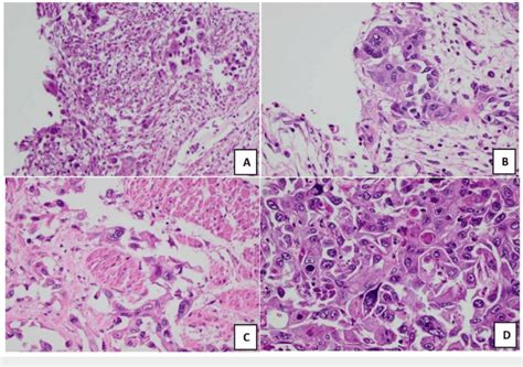A Scc Invasion Of Bladder Trigonal Epithelium B Scc Invasion Of