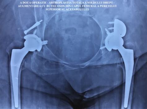 ⚫ Prin Displazia Soldului Luxatia Dr Andrei Anastasiu