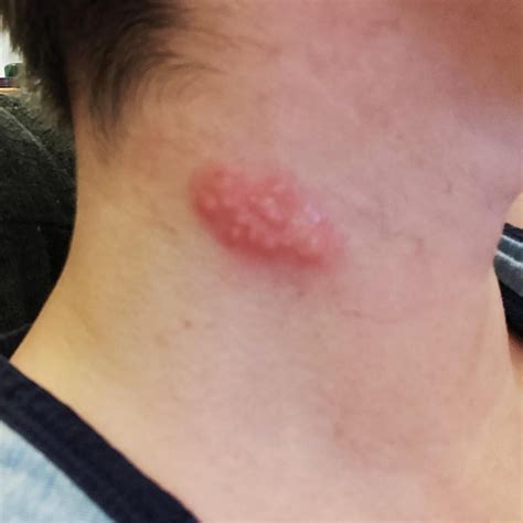Neck Turning Red W White Bumps Itchy Stings Help Please R Dermatologyquestions